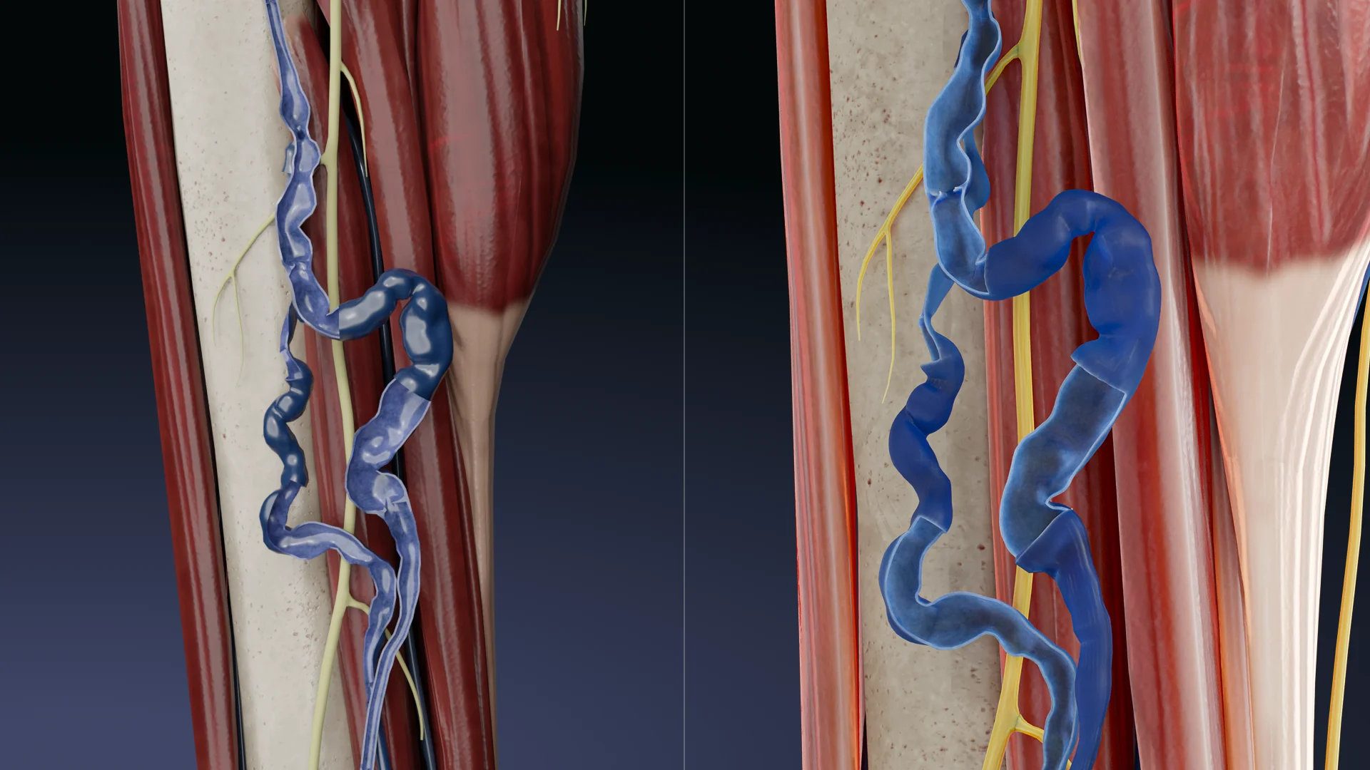 Varices : symptômes, causes, diagnostic, stades et traitement